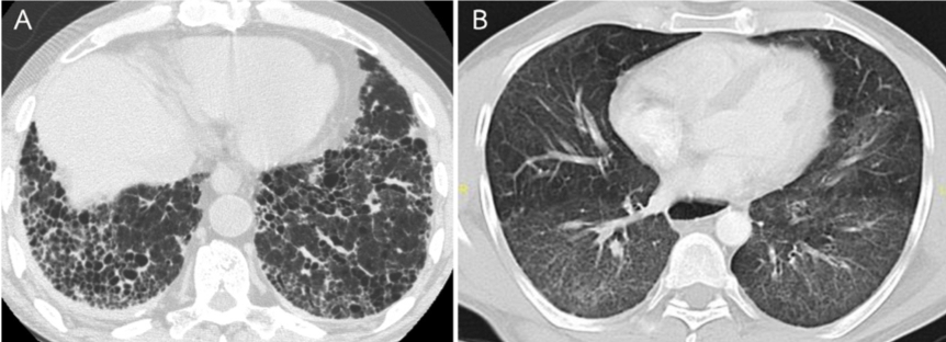ILD in IIM | ThaiChest
