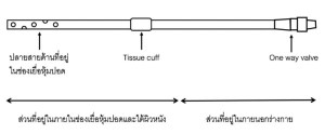 Pleural catheter | ThaiChest
